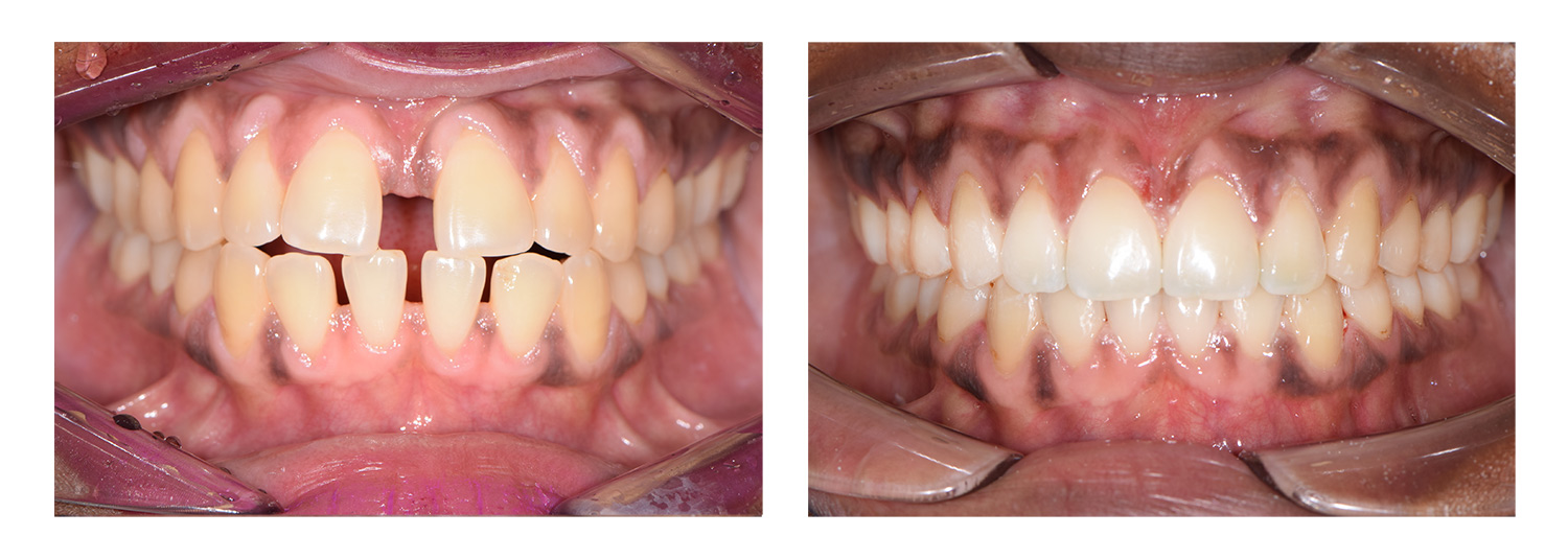 Before & After - Cynthia Carbone, Orthodontist in Montreal