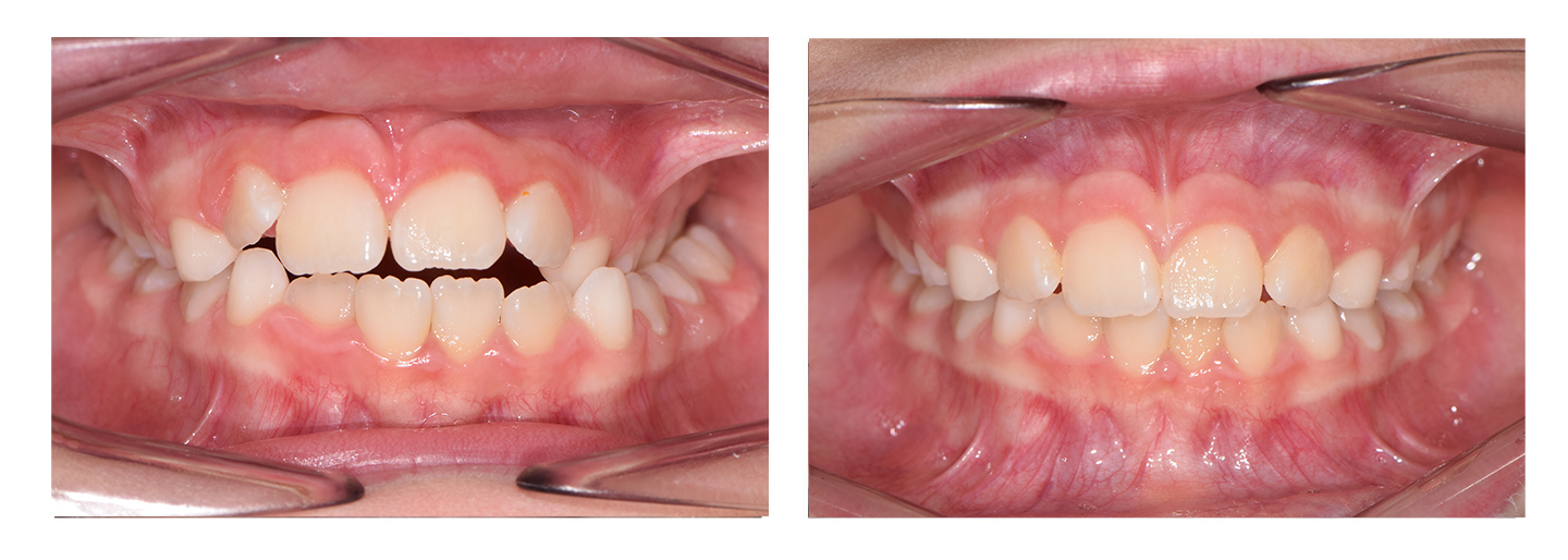 Before & After - Cynthia Carbone, Orthodontist in Montreal